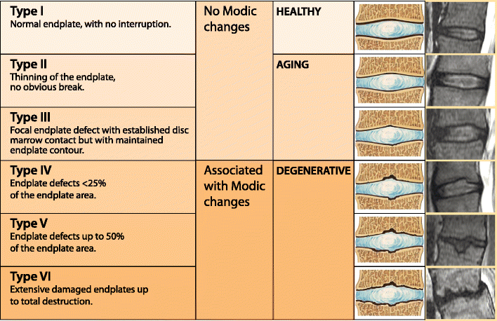 ABCs of the degenerative spine | SpringerLink