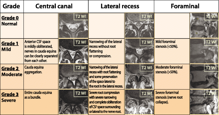 ABCs of the degenerative spine | Insights into Imaging | Full Text