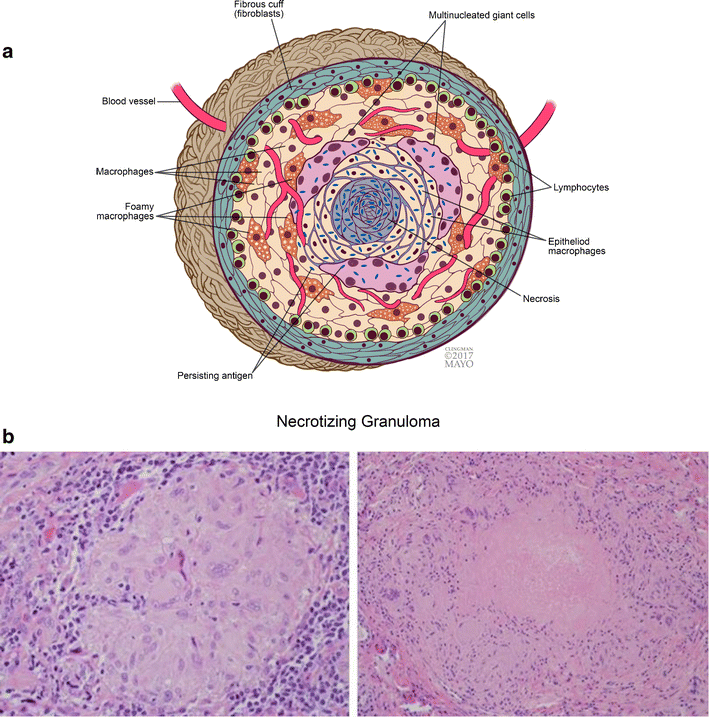 Granulomatous diseases of the breast and axilla: radiological findings ...
