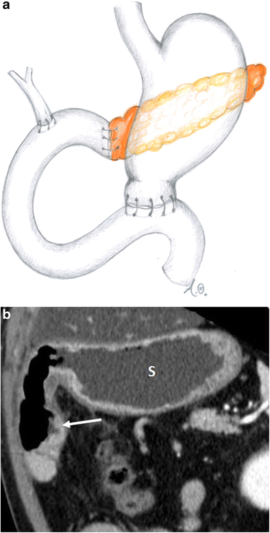 Major pancreatic resections: normal postoperative findings and ...
