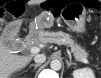 Major pancreatic resections: normal postoperative findings and ...