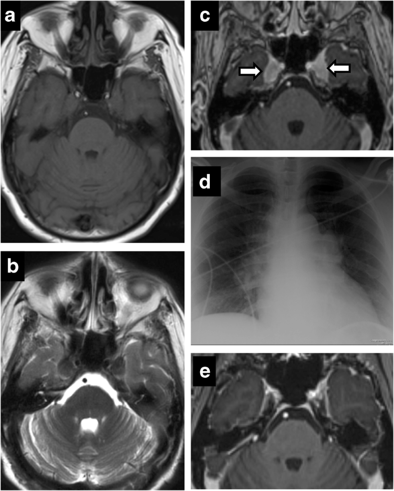 Neuroimaging of Meckel’s cave in normal and disease conditions ...