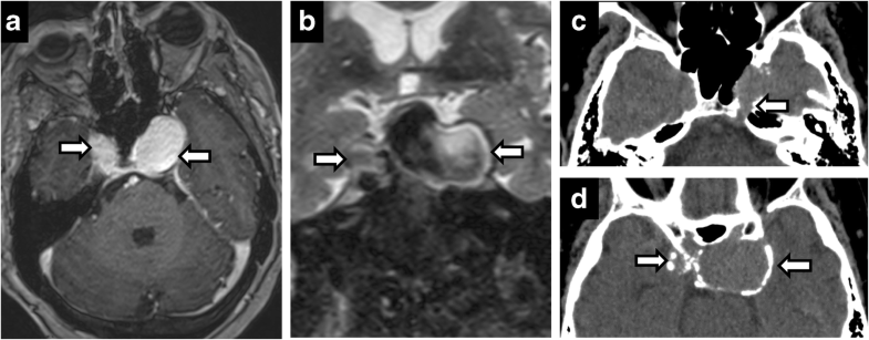Neuroimaging of Meckel’s cave in normal and disease conditions ...