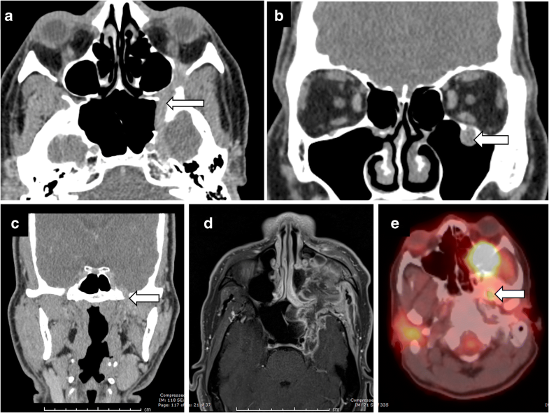 Neuroimaging of Meckel’s cave in normal and disease conditions ...