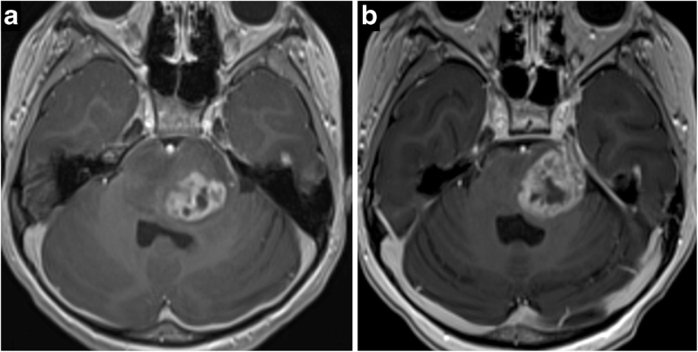Neuroimaging of Meckel’s cave in normal and disease conditions ...