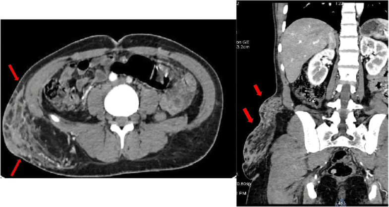 Spectrum of gastrointestinal lesions of neurofibromatosis type 1: a ...
