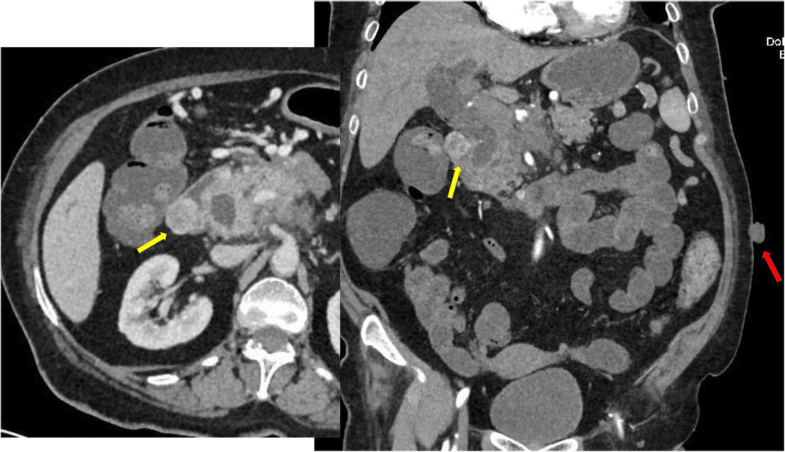 Spectrum of gastrointestinal lesions of neurofibromatosis type 1: a ...