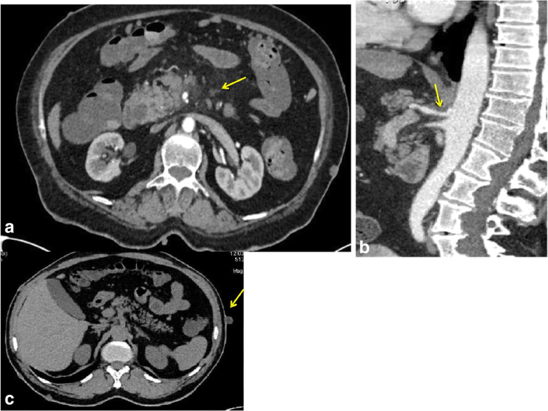Spectrum of gastrointestinal lesions of neurofibromatosis type 1: a ...