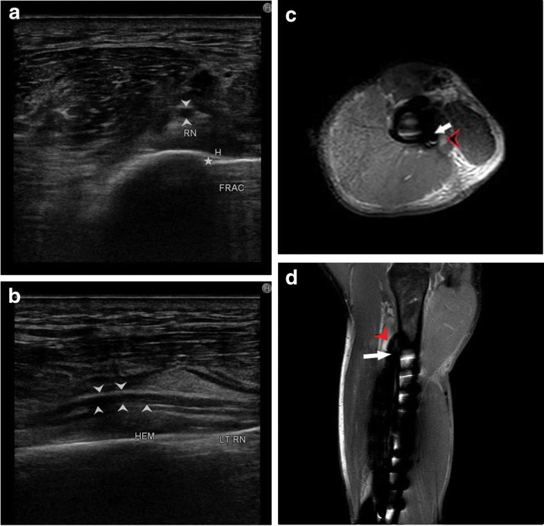 A panorama of radial nerve pathologies- an imaging diagnosis: a step ...