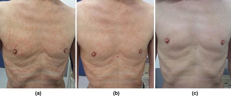 Drug-Induced Generalized Skin Eruption in a Diabetes Mellitus Patient ...