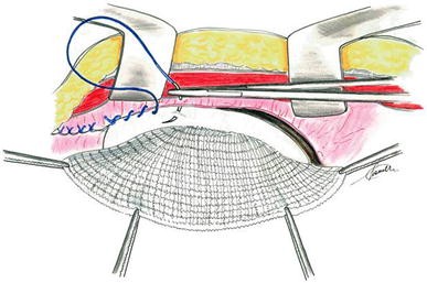 A new technique for tension-free reconstruction in large incisional ...