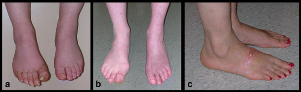 Immunotherapy Prospects for Painful Small-fiber Sensory Neuropathies ...