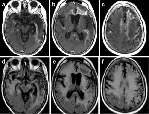 Herpes Simplex Virus-1 Encephalitis in Adults: Pathophysiology ...