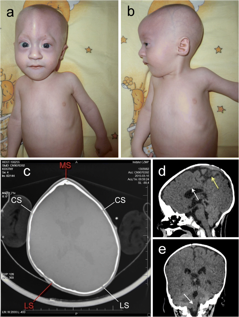 Novel 1q22-q23.1 duplication in a patient with lambdoid and metopic ...