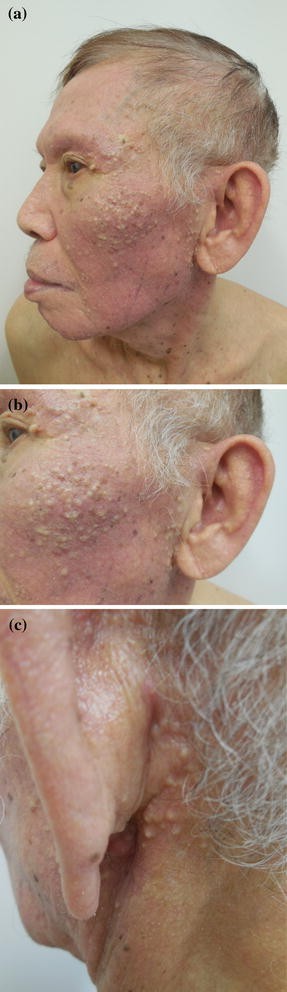 Sorafenib-Associated Facial Acneiform Eruption | SpringerLink