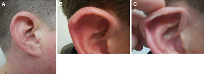 Darwin’s Tubercle: Review of a Unique Congenital Anomaly | SpringerLink