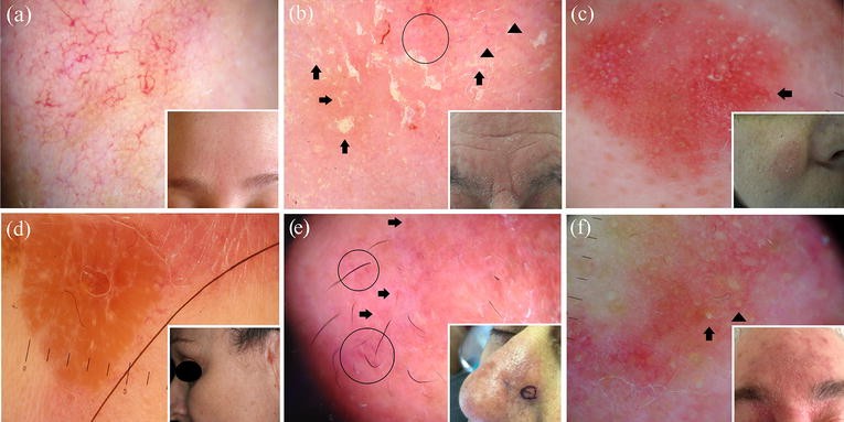 Dermoscopy in General Dermatology: A Practical Overview | SpringerLink