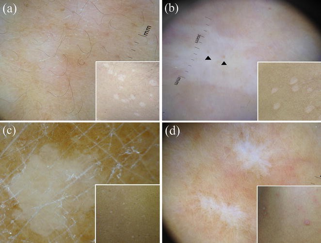 Dermoscopy in General Dermatology: A Practical Overview | SpringerLink