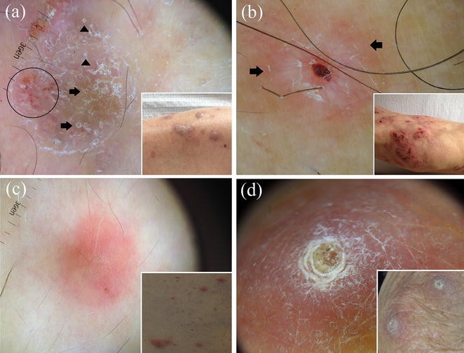 Dermoscopy in General Dermatology: A Practical Overview | SpringerLink