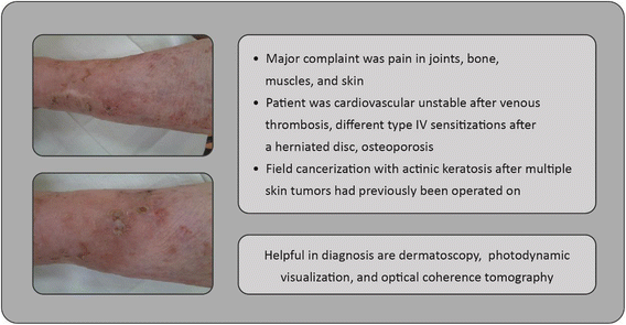 Skin Cancer: Epidemiology, Disease Burden, Pathophysiology, Diagnosis ...
