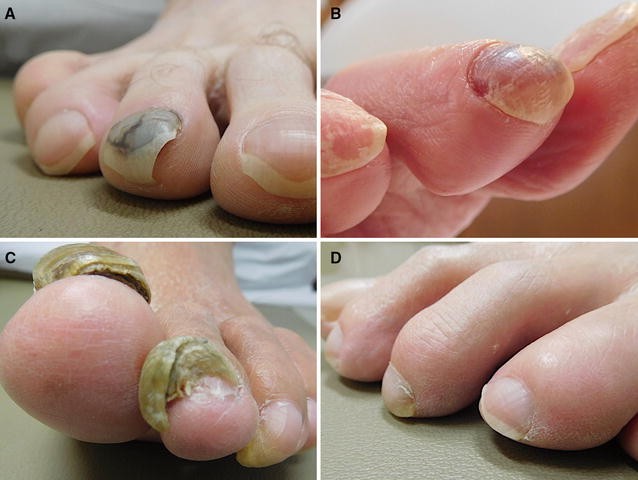 Parrot Beak Nails Revisited: Case Series and Comprehensive Review ...