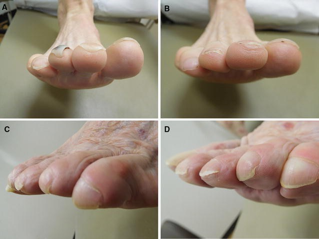 Parrot Beak Nails Revisited: Case Series and Comprehensive Review ...