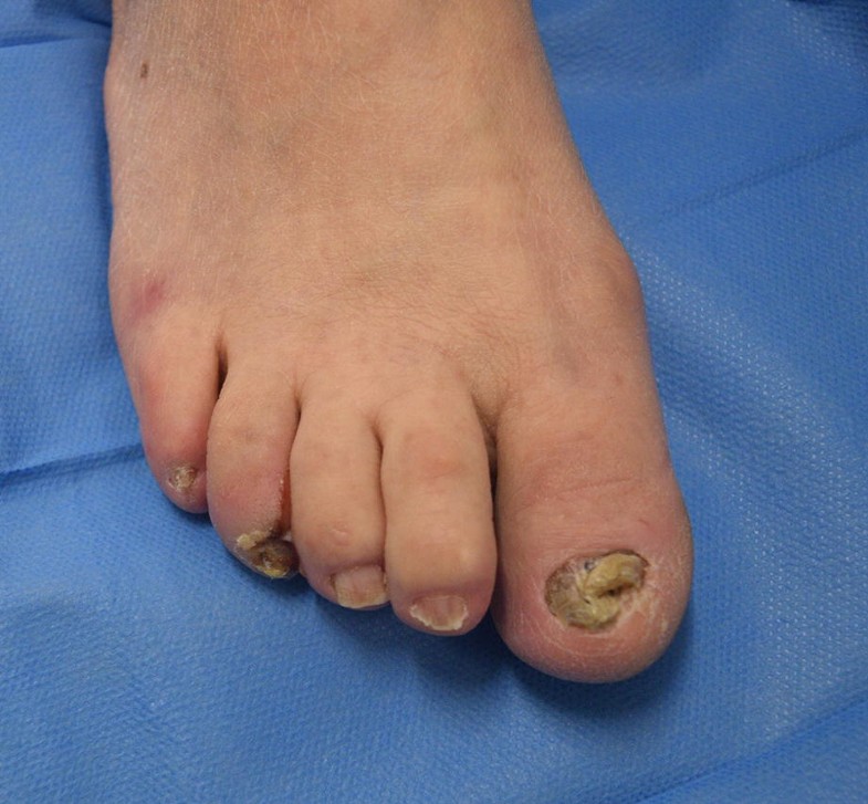 Squamous Cell Carcinomas in Two Cases of Nail Lichen Planus: Is There a ...