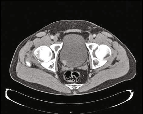 Case report. Het beloop van een onbehandelde, laaggradige blaastumor ...