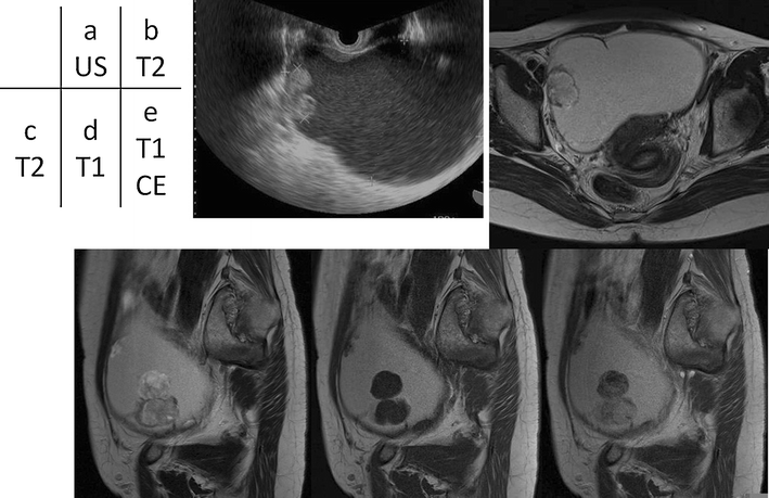 Clinical Management of Ovarian Endometriotic Cyst (Chocolate Cyst ...
