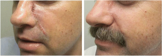 Laser Revision and Rehabilitation of Mohs Micrographic Surgical Scars ...