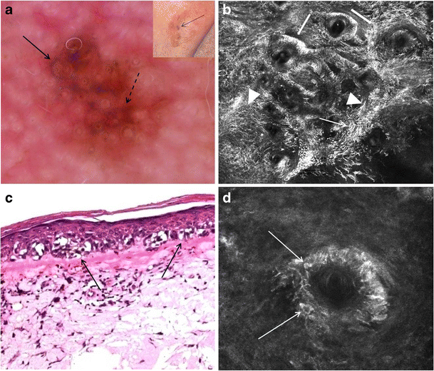 Confocal Microscopy in Skin Cancer | SpringerLink
