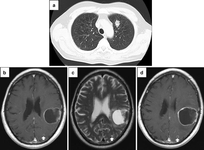 Cystic brain metastasis of non-small-cell lung cancer successfully ...