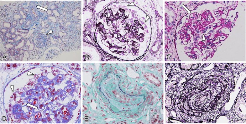 A case of secondary focal segmental glomerulosclerosis associated with ...