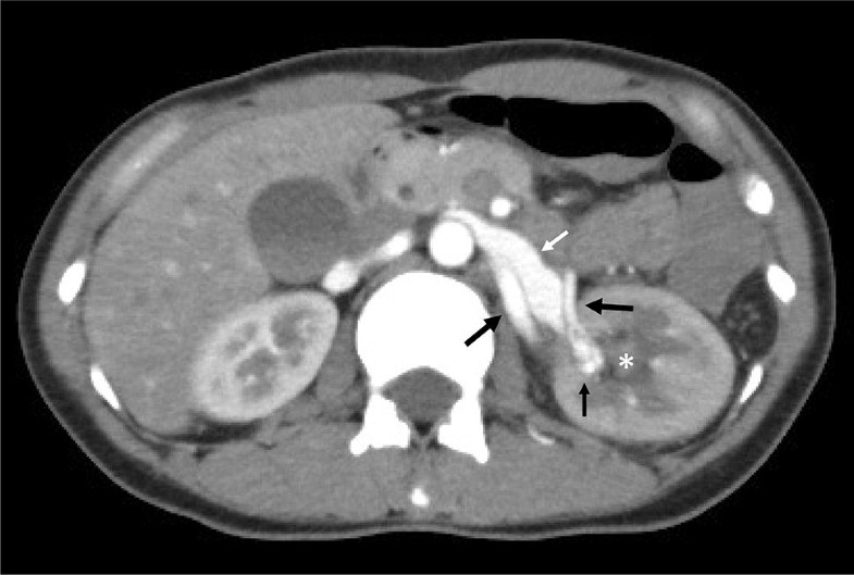 Arteriovenous fistula-related renal bleeding 5 days after percutaneous ...