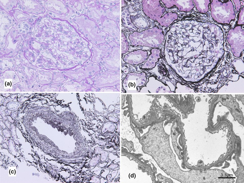 Arteriovenous fistula-related renal bleeding 5 days after percutaneous ...