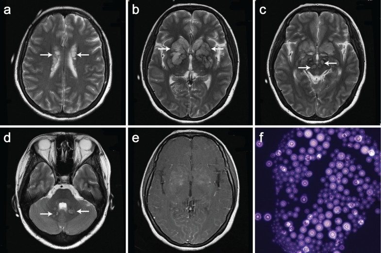 Magnetic resonance imaging features of gelatinous pseudocysts in ...