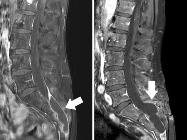 A case of Capnocytophaga canimorsus sacral abscess in an ...