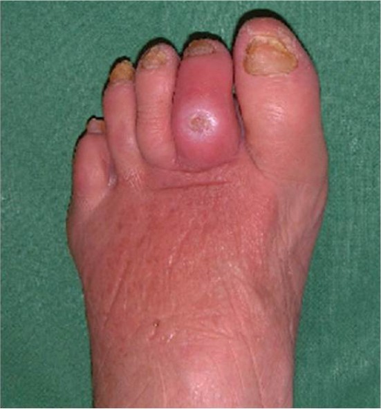 Therapie bei bakteriellen Infektionen der Zehen | SpringerLink