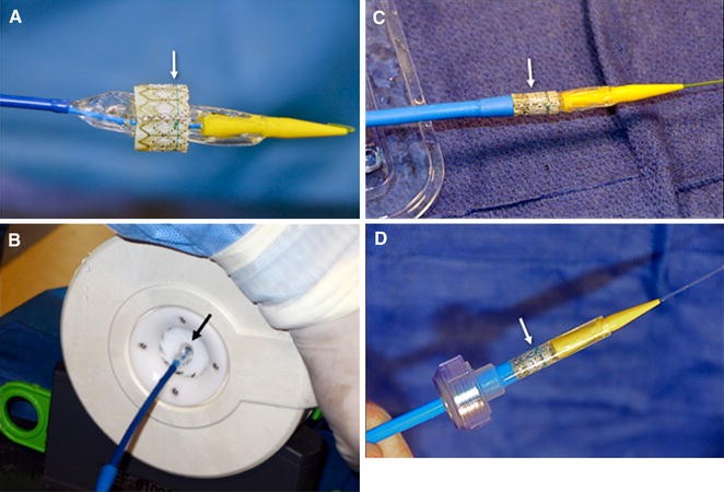 The Edwards SAPIEN Transcatheter Heart Valve for Calcific Aortic ...