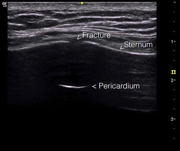 Ultrasound-Guided Parasternal Block Allows Optimal Pain Relief and ...