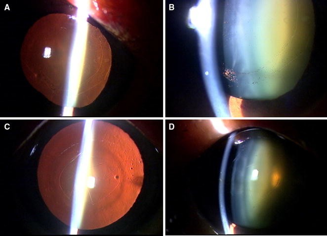 Multiple Layers Lens Capsule True Exfoliation in Patient with Primary ...