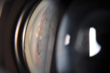 The New Era of Glaucoma Micro-stent Surgery | SpringerLink