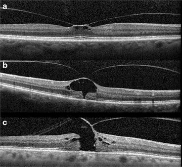 Ocriplasmin for Treatment of Vitreomacular Traction: An Update ...
