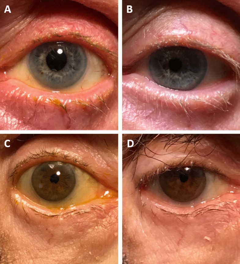 An Evaluation of Staphylococci from Ocular Surface Infections Treated ...