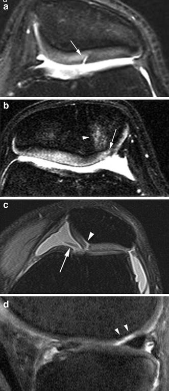 MRI of the Knee: What Do We Miss? | SpringerLink
