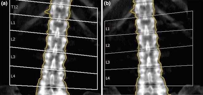 A Practical Approach to Interpretation of Dual-Energy X-ray ...