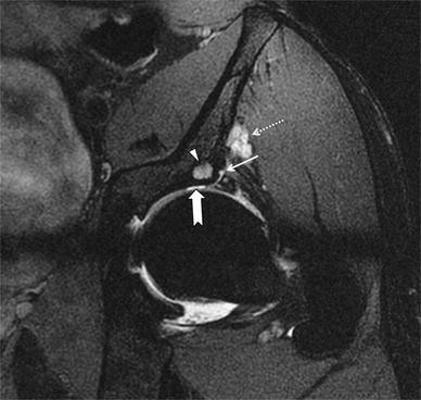 MRI of the Hip: Important Injuries of the Adult Athlete | SpringerLink