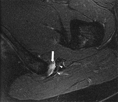 MRI of the Hip: Important Injuries of the Adult Athlete | SpringerLink