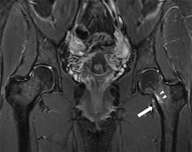 MRI of the Hip: Important Injuries of the Adult Athlete | SpringerLink