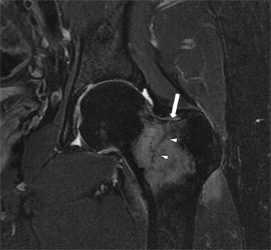 MRI of the Hip: Important Injuries of the Adult Athlete | SpringerLink